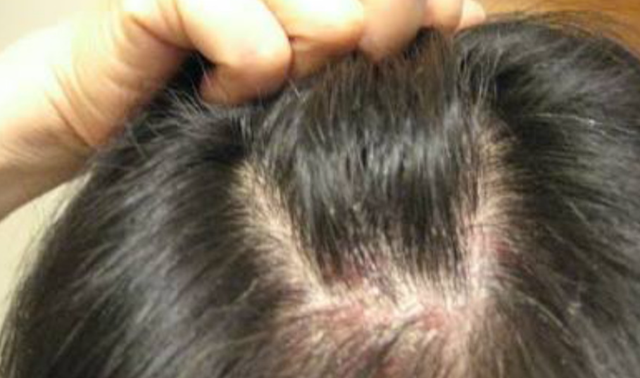 Perbedaan Ketombe dan Psoriasis di Kulit Kepala | SiberZone Indonesia